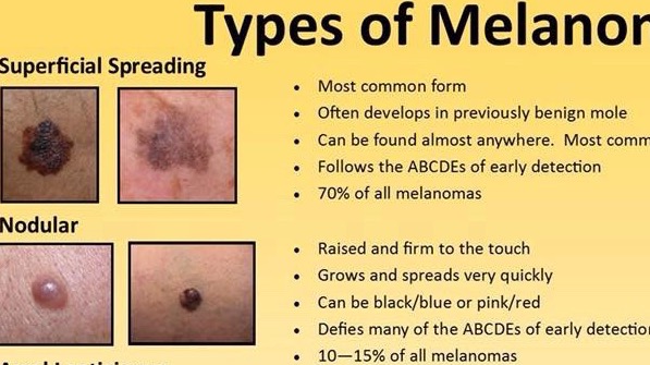 Clinician / Cancer Survivor: # 4 Z-Zebra